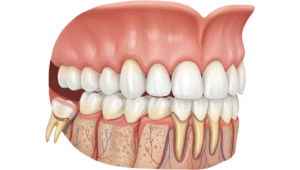 Vertical Impacted Wisdom Tooth: Causes & Treatment
